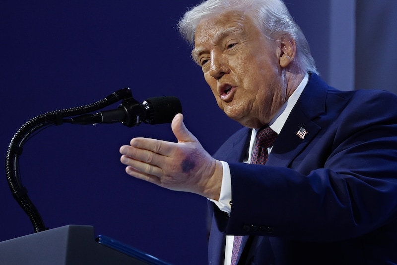 Trump bagatelliseert blauwe plekken: alleen maar ‘hand gestoten aan ...