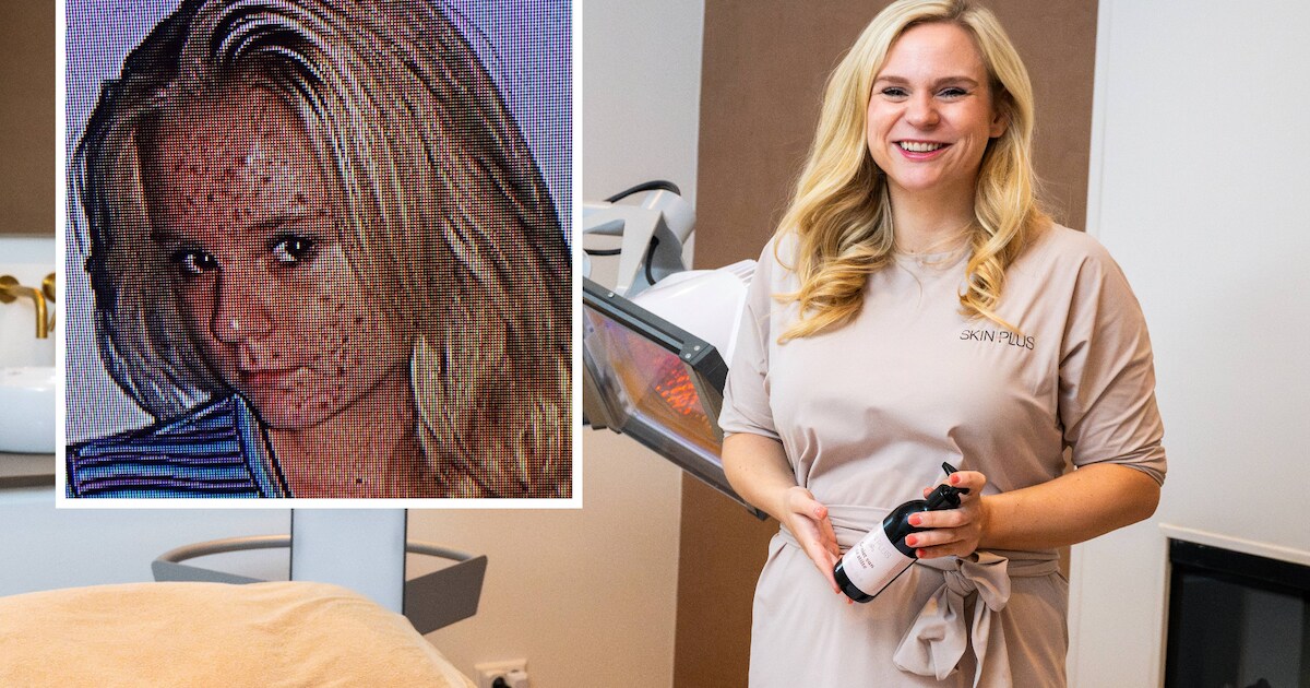 Als 12-jarige stond Melissa bekend als ‘het meisje met acne’: nu is dat ...