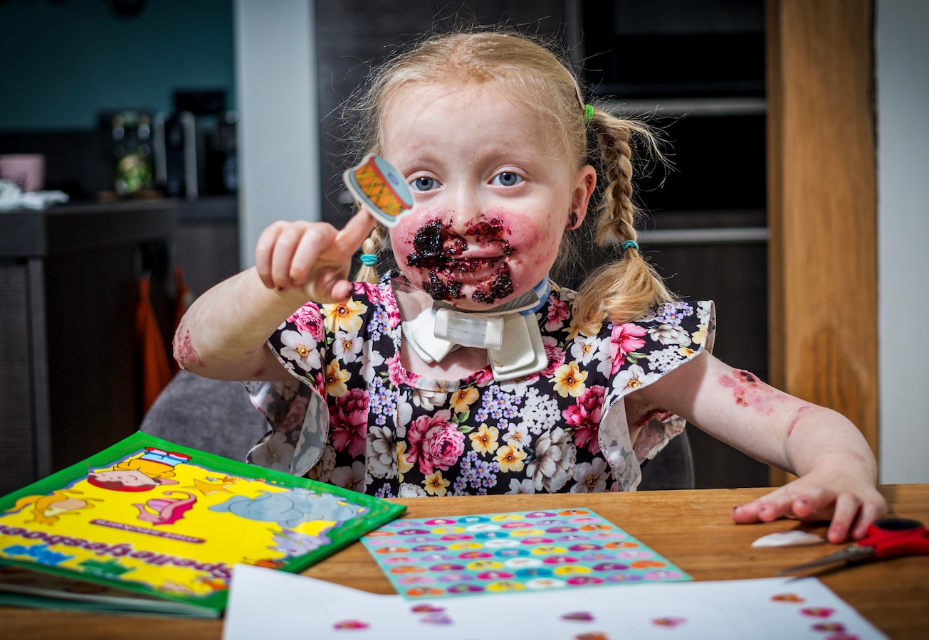 Danielle heeft een huid zo kwetsbaar als een vlinder, zelfs knuffelen ...