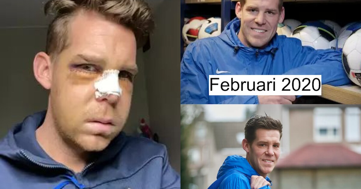 Emiel brak zijn gezicht op acht plaatsen, maar nu voetbalt hij weer ...