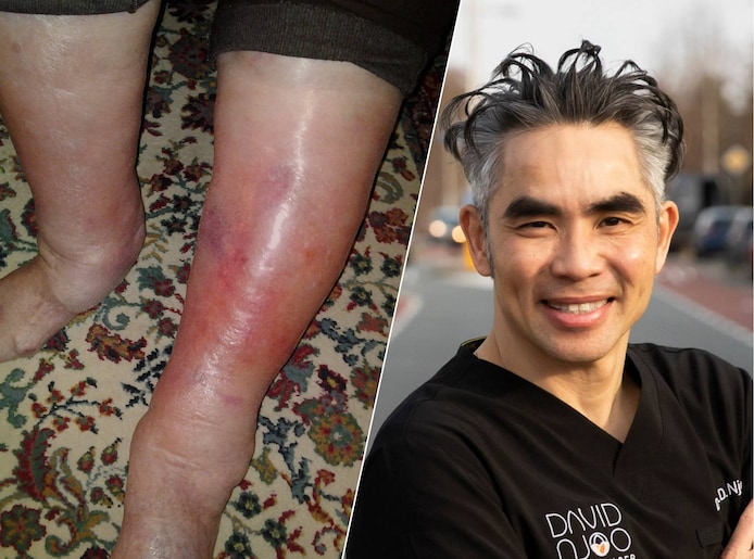 Eerst ‘slechts’ een wondje, dan een opgezwollen en pijnlijk been: dit ...