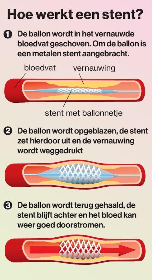 Cardioloog Cheng zet oplosbare stent in bij patiënten: veel dunner ...