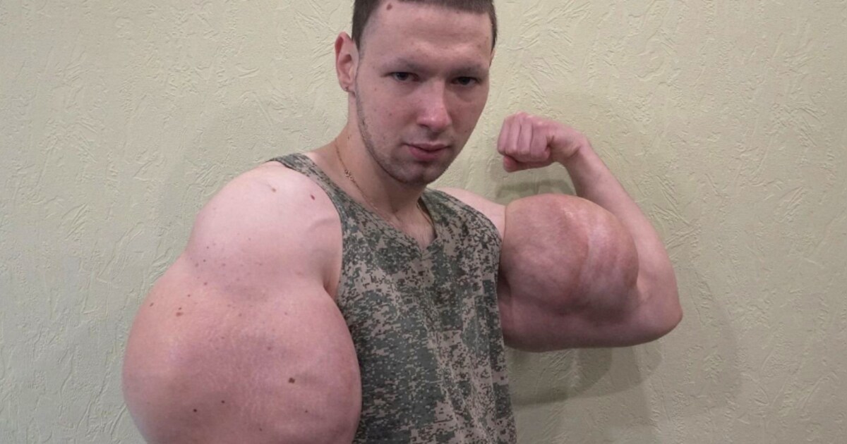 Popeye-bodybuilder wil af van met olie gevulde megabiceps | Bizar | AD.nl