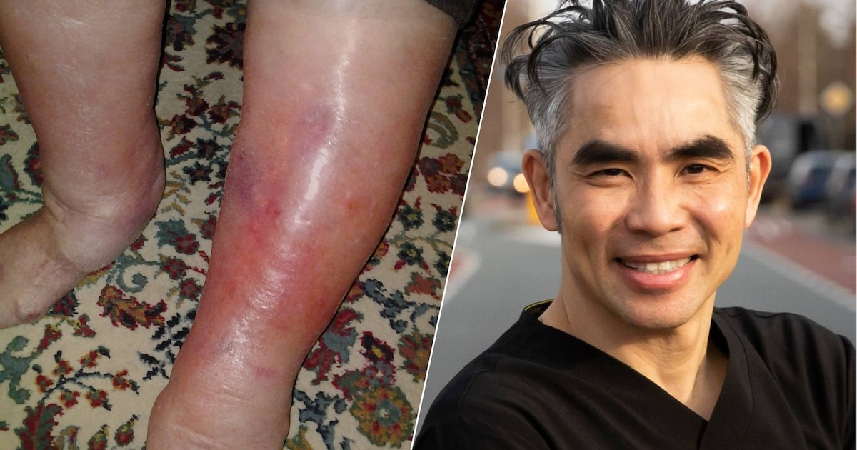 Eerst ‘slechts’ een wondje, dan een opgezwollen en pijnlijk been: dit ...