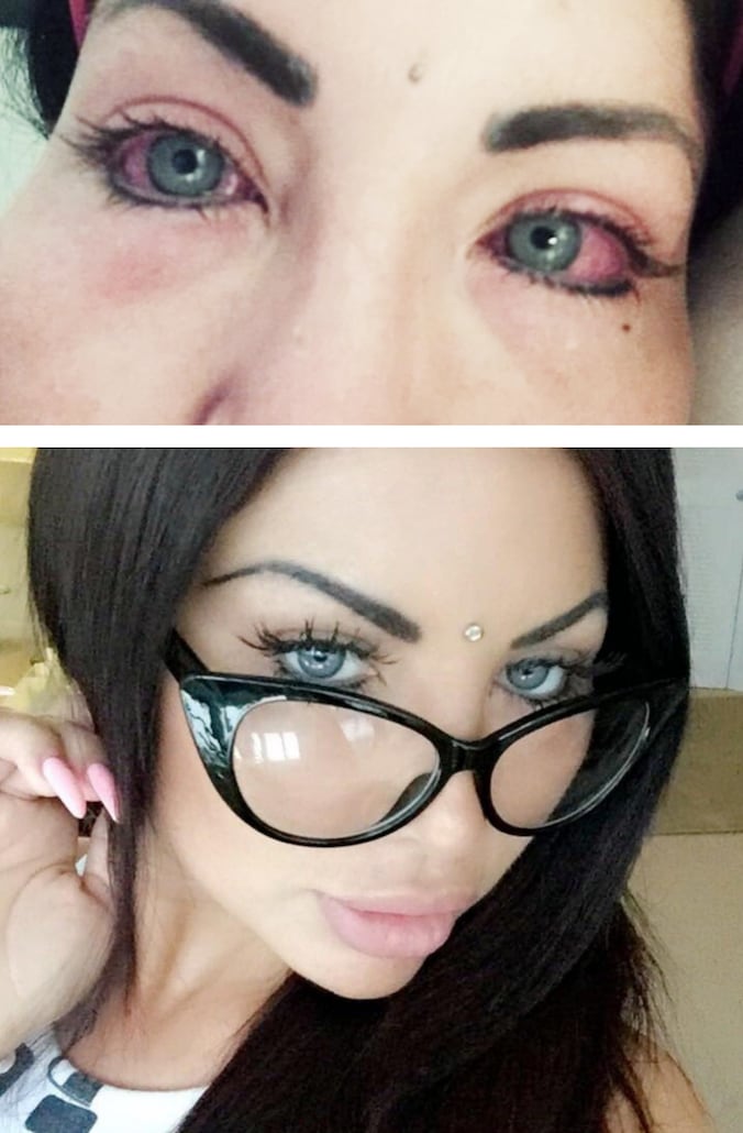 Instagram-model bijna blind na operatie met gekleurde oogimplantaten ...