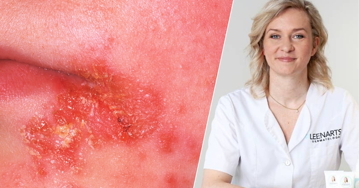 Wat is krentenbaard? Dermatoloog legt uit: ‘Kan er heftig uitzien ...