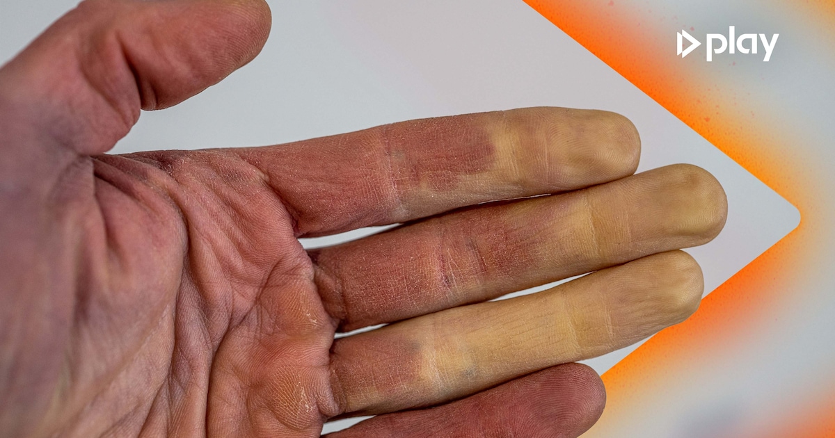 Zijn blauwe of witte vingers gevaarlijk? Een reumatoloog legt het uit ...